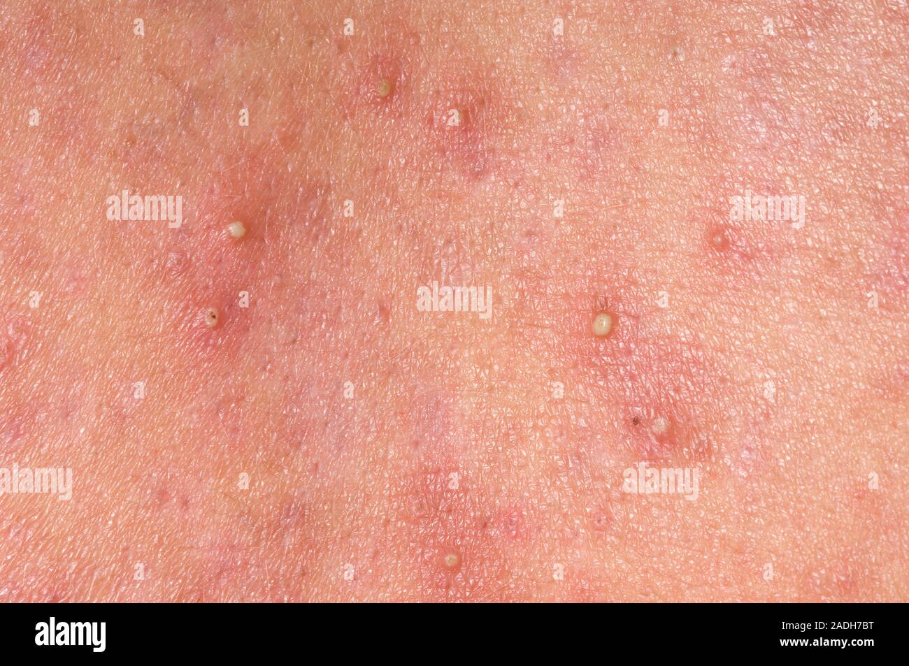 Acne vulgaris on a 24 year old man's back. Acne is a general name given ...