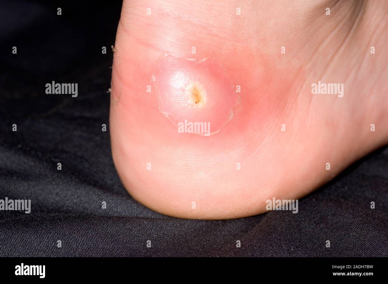 Abscess on a 6 year old boy's heel. An abscess is a painful pus-filled ...