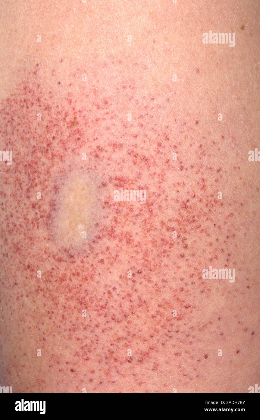 Angioma serpiginosum. Close-up of red dots around the site of an old ...