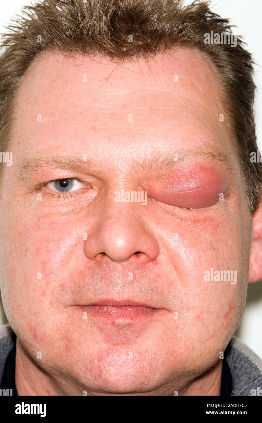 MODEL RELEASED. Abscess. Image 1 of 2. Abscess on a 45-year-old man's ...