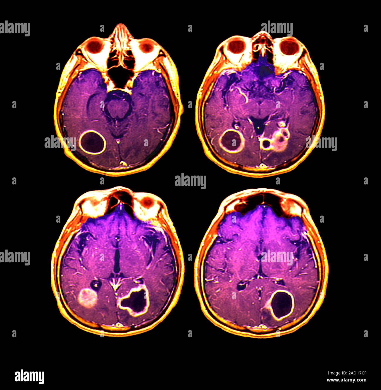 Brain abscesses. Coloured magnetic resonance imaging (MRI) scans of an ...