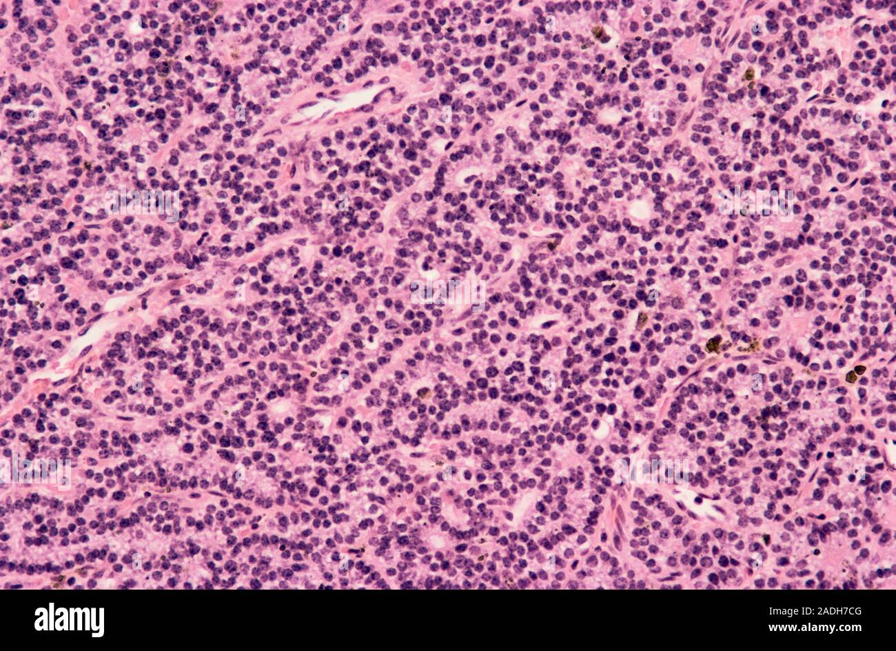 Parathyroid gland adenoma. Light micrograph of a section through an ...