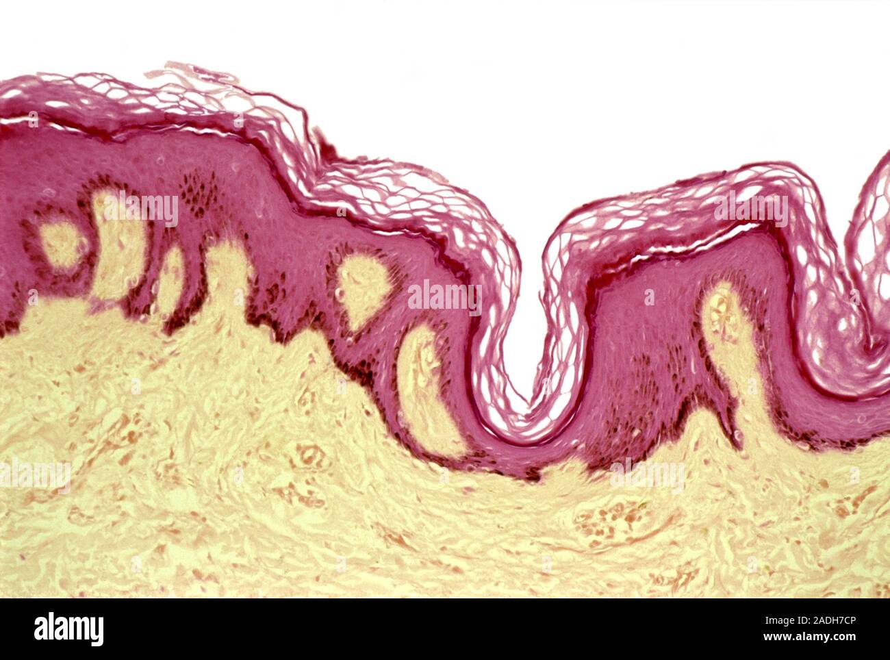 Skin pigmentation from Addison's disease. Light micrograph of a section ...