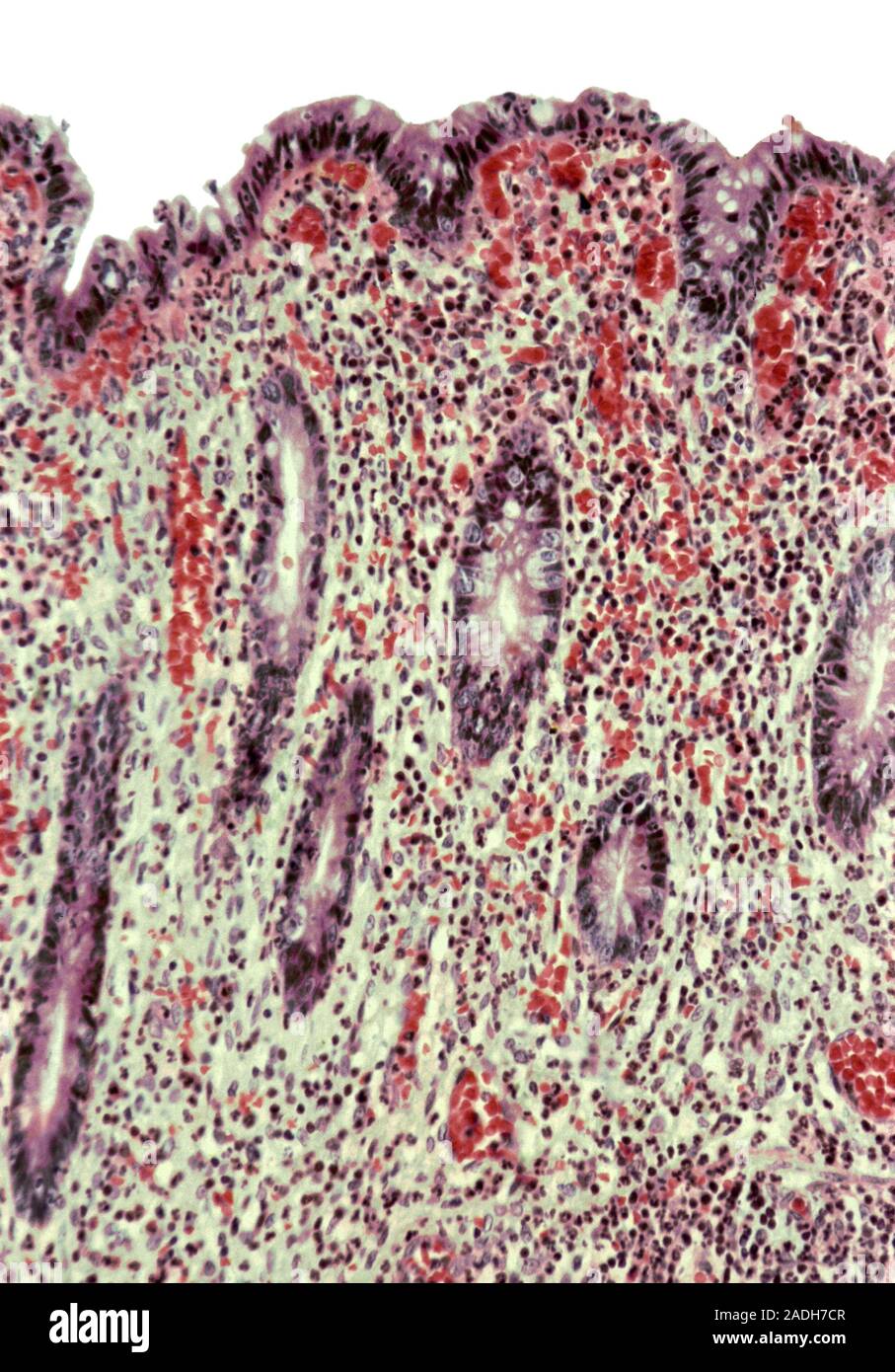 Appendicitis. Light micrograph through a section of an appendix showing ...