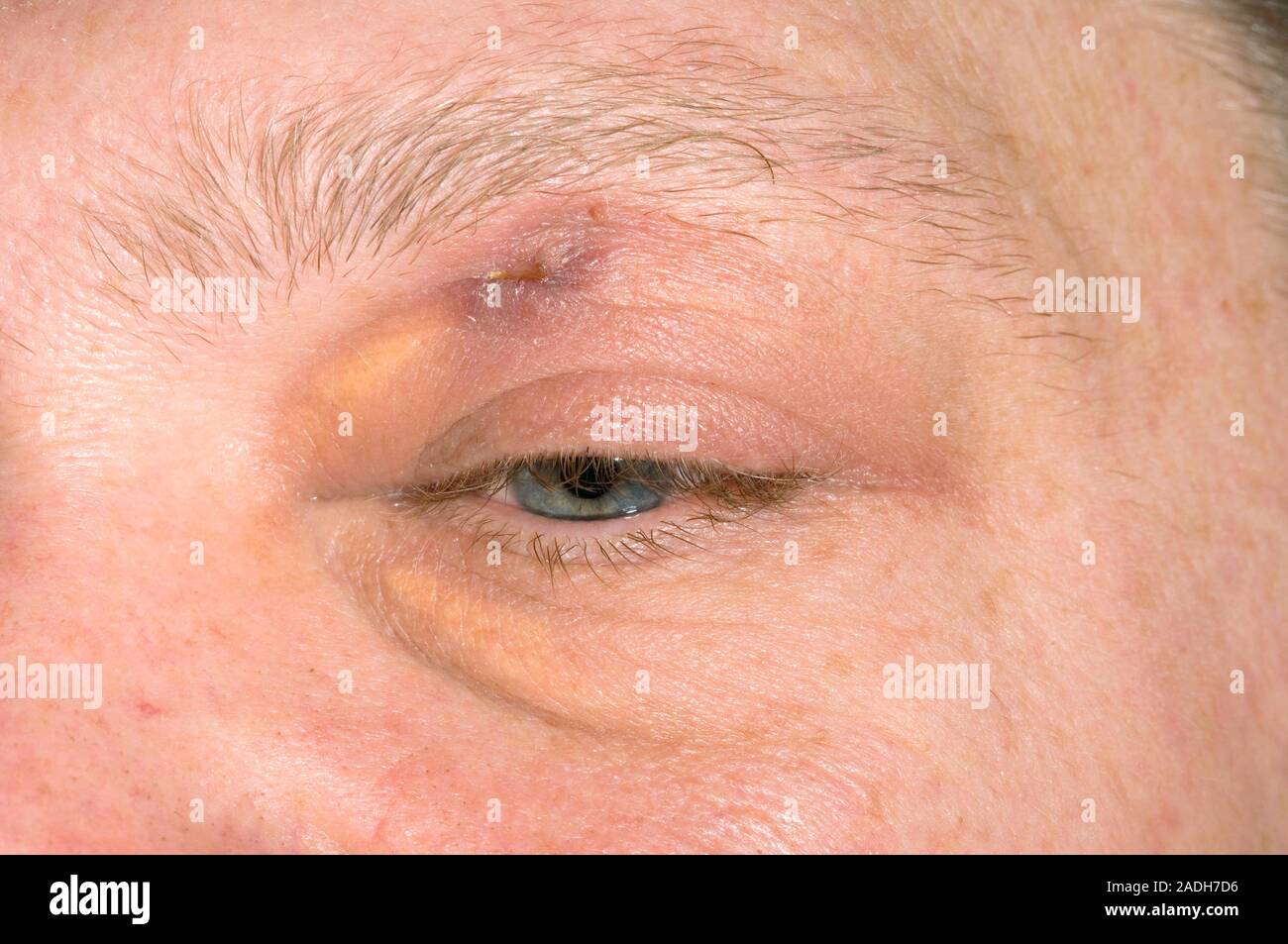 Healing abscess (upper centre) on a 45-year-old man's eyelid. This is ...
