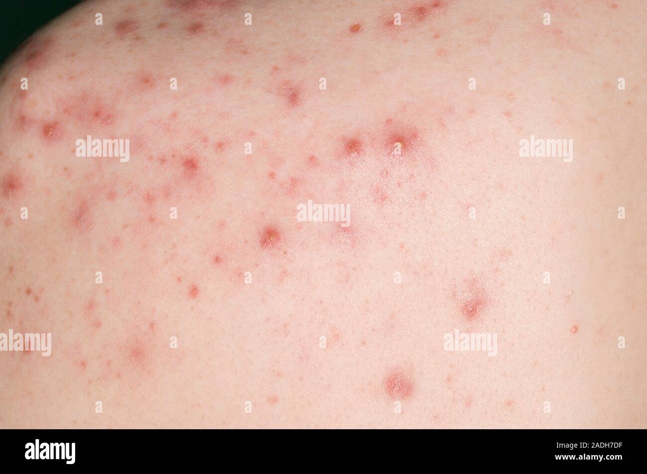 Back acne. Acne vulgaris on a 15 year old boy's back. Acne is a general ...