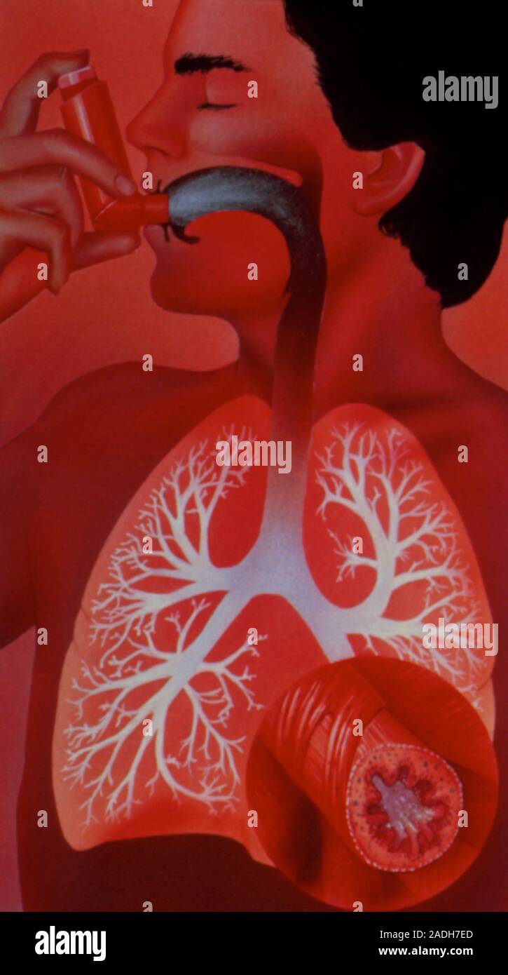 Illustration showing the use of a Ventolin inhaler to control recurrent ...
