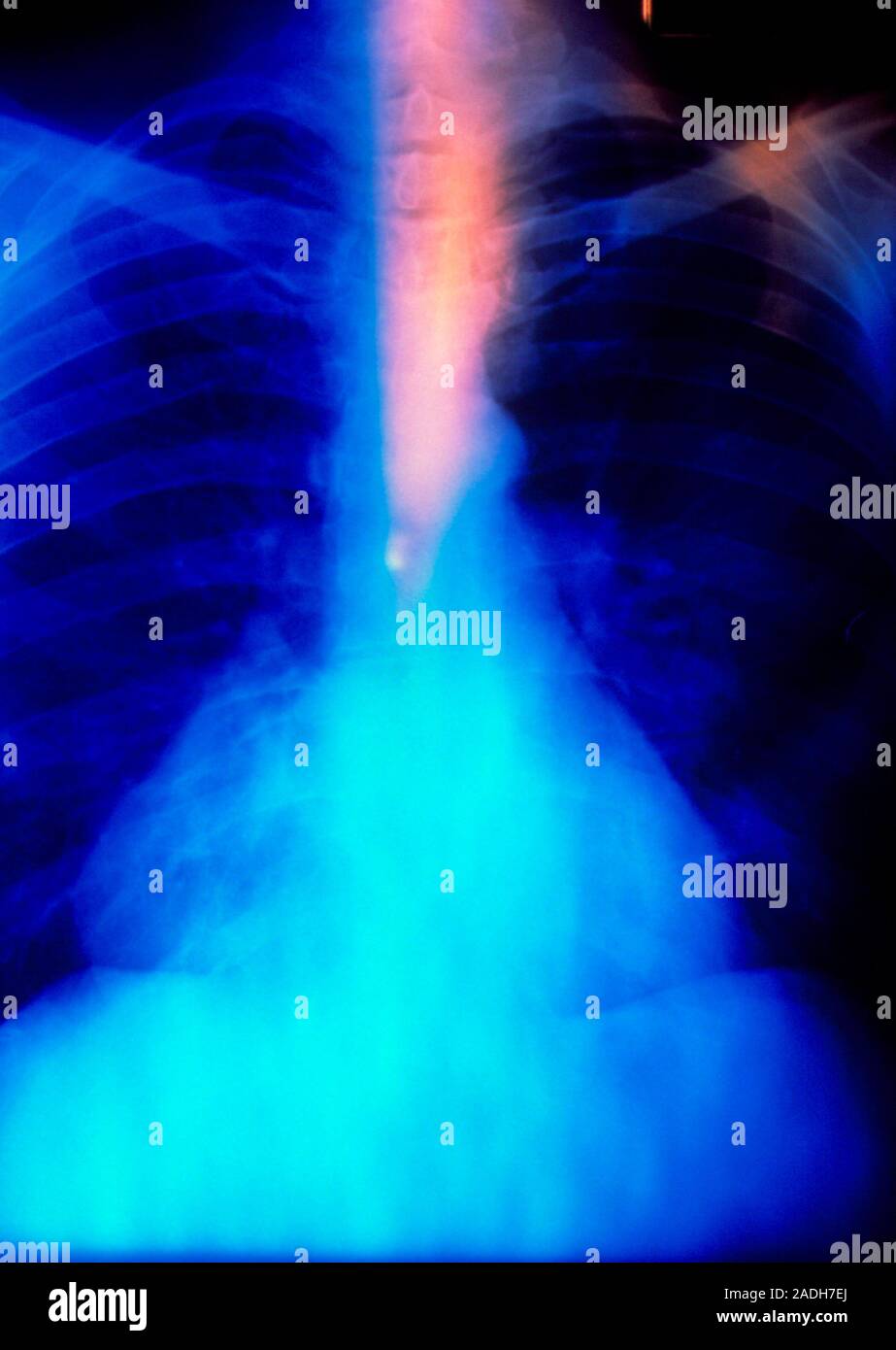Asthma. Coloured chest X-ray of person suffering from asthma, showing a ...
