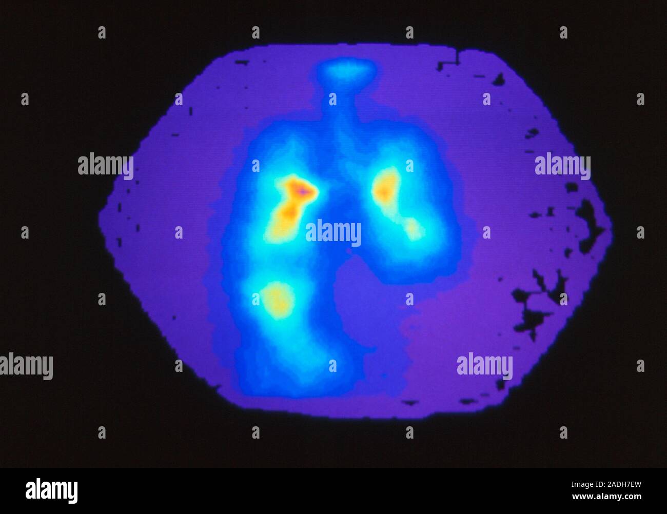 Lungs of asthmatic. Coloured Gamma Camera scan (scintigram) of the ...