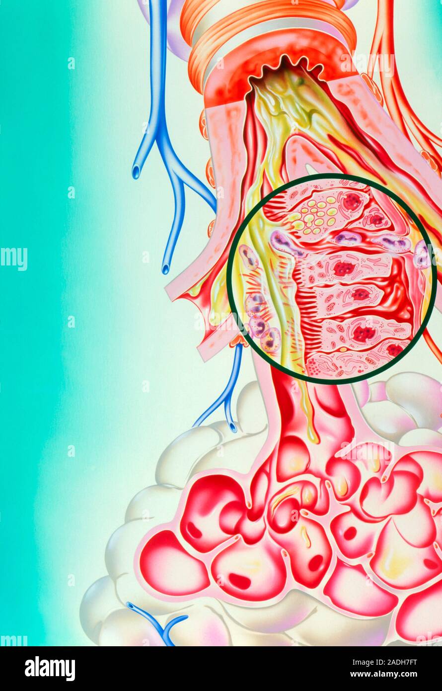 Asthma. Cut-away illustration of the respiratory system showing the ...