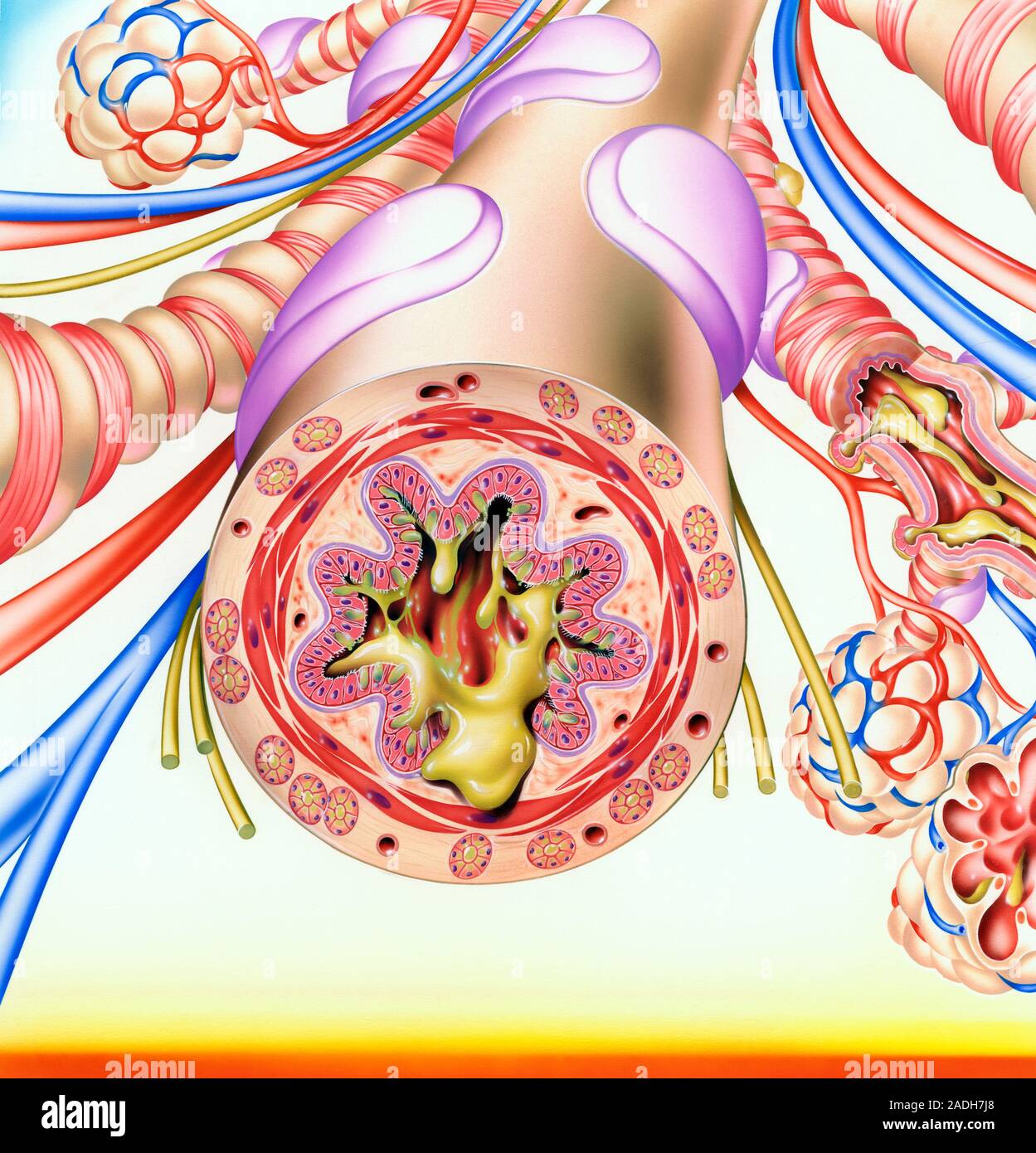 Asthma. Artwork of a lung bronchiole that has been sectioned to show ...
