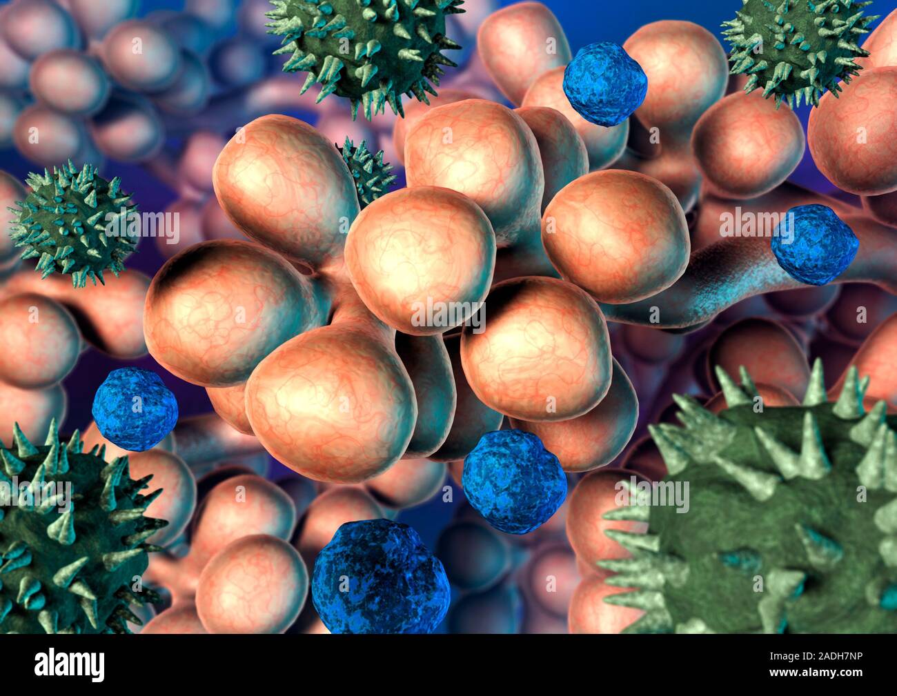 Asthma. Computer artwork of allergens (blue and green) amongst alveoli ...