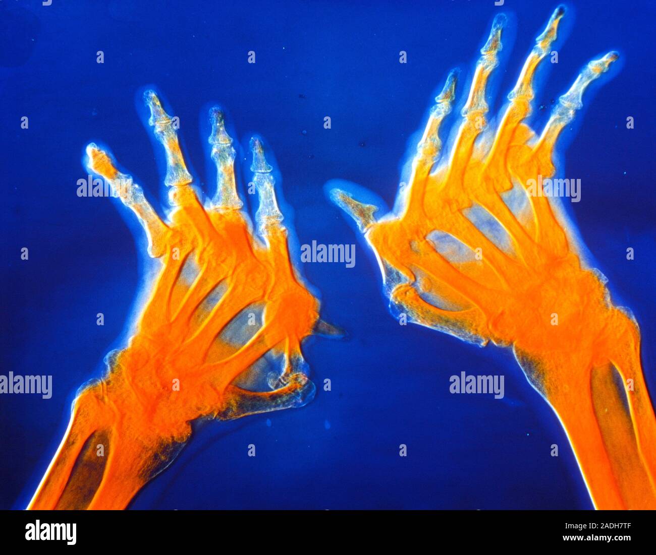 X-ray of the hands of a person suffering from extreme rheumatoid ...