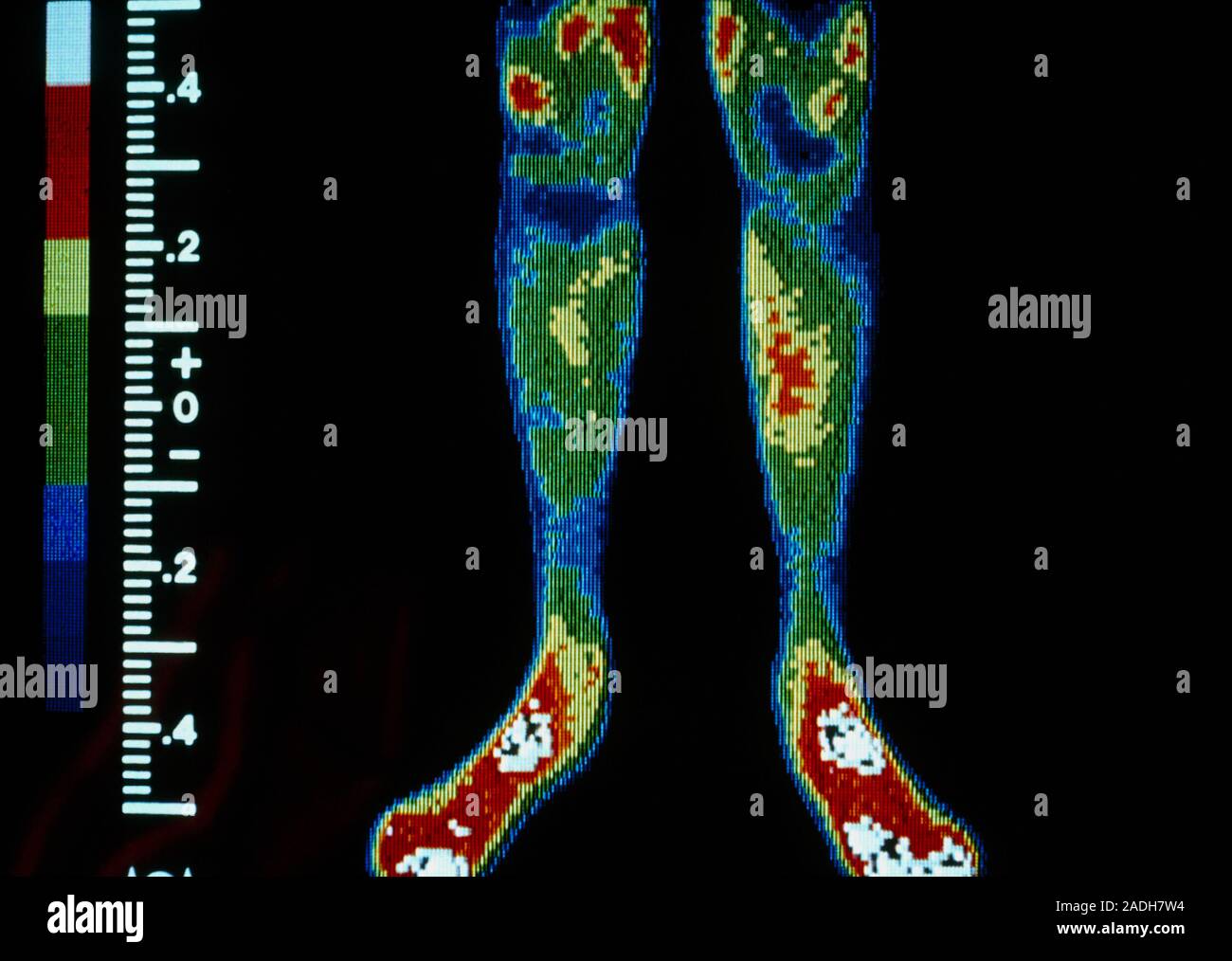 Thermogram of the lower legs of someone suffering from rheumatoid ...