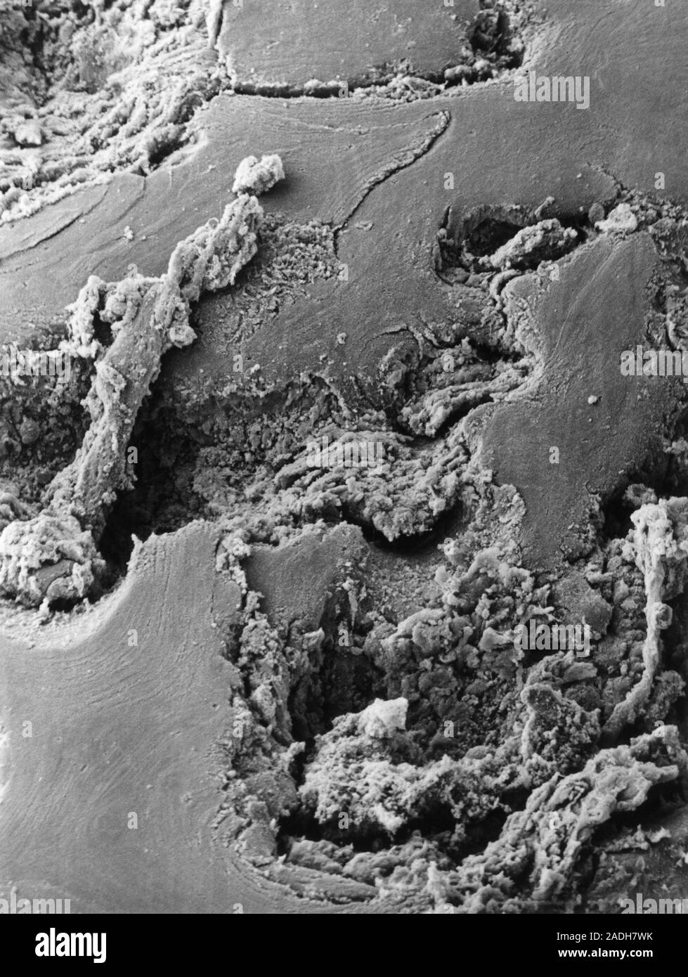 Scanning electron micrograph of the head of a human femur (thigh bone ...