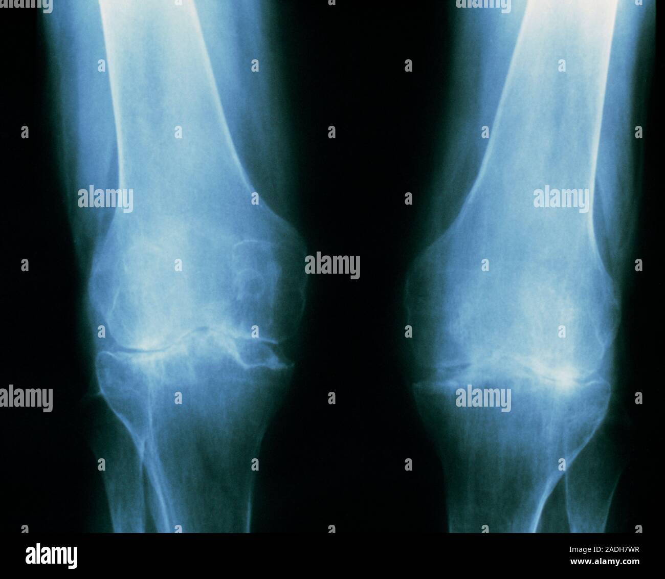 False-colour X-ray showing erosion of both knee joints due to ...