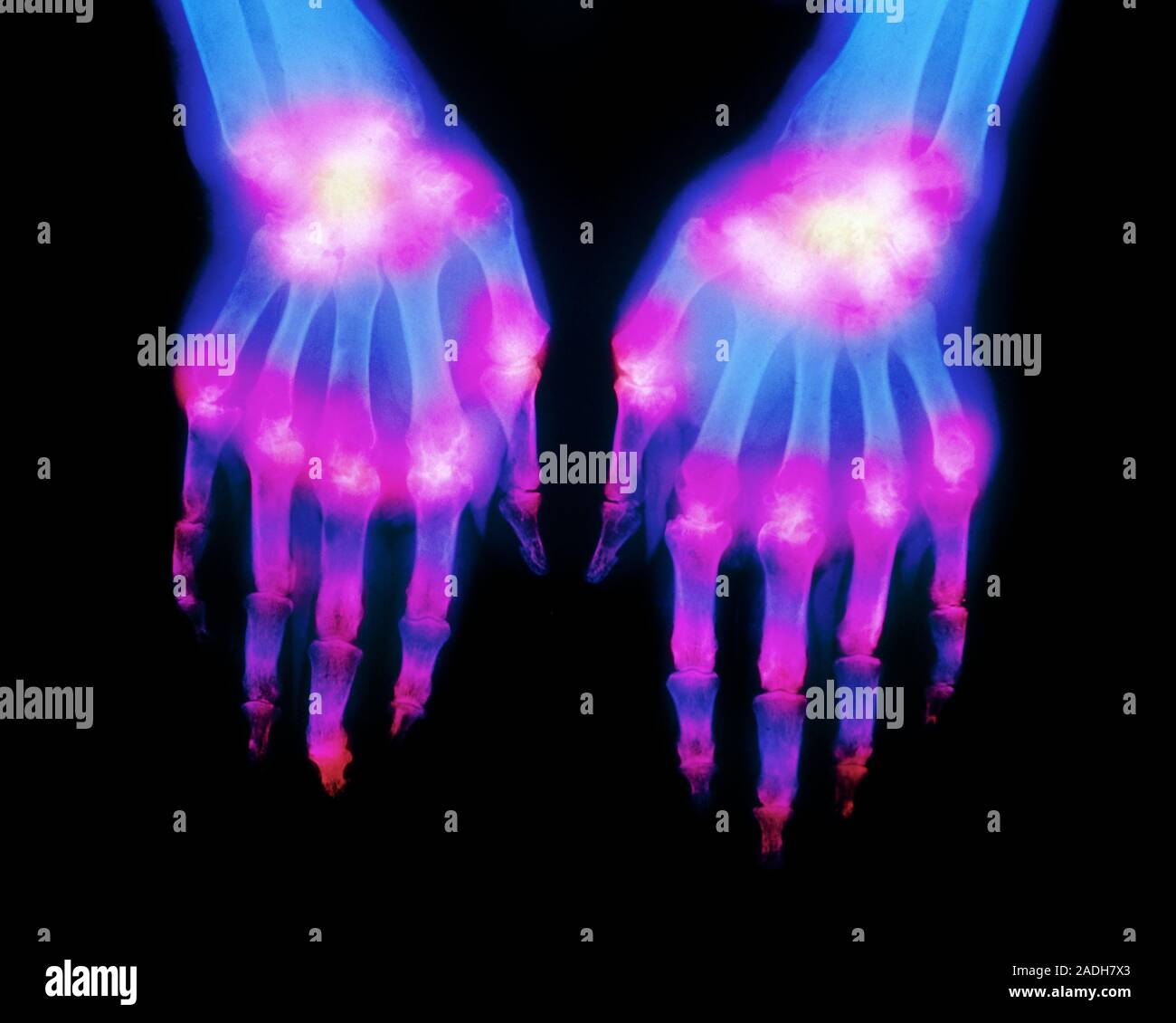 False-colour X-ray of an arthritic hand showing deformation and ...