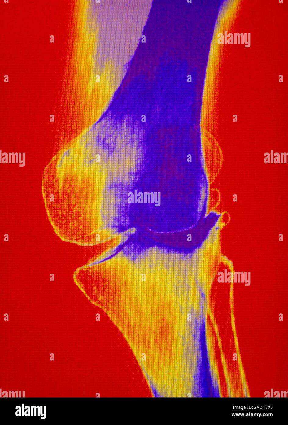False-colour X-ray showing erosion of the knee joint due to rheumatoid ...