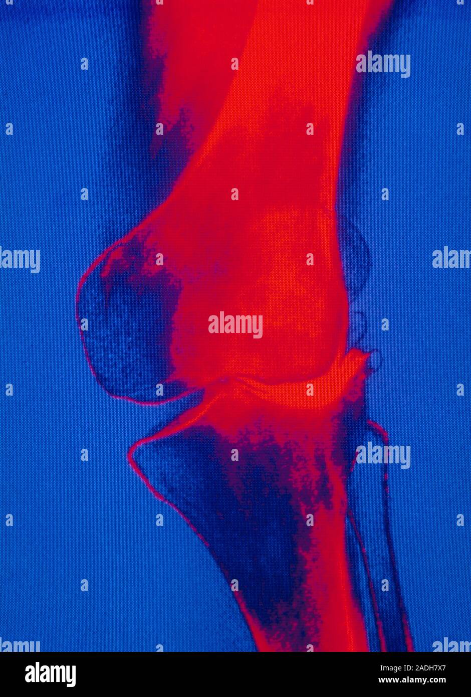 False-colour X-ray showing erosion of the knee joint due to rheumatoid ...