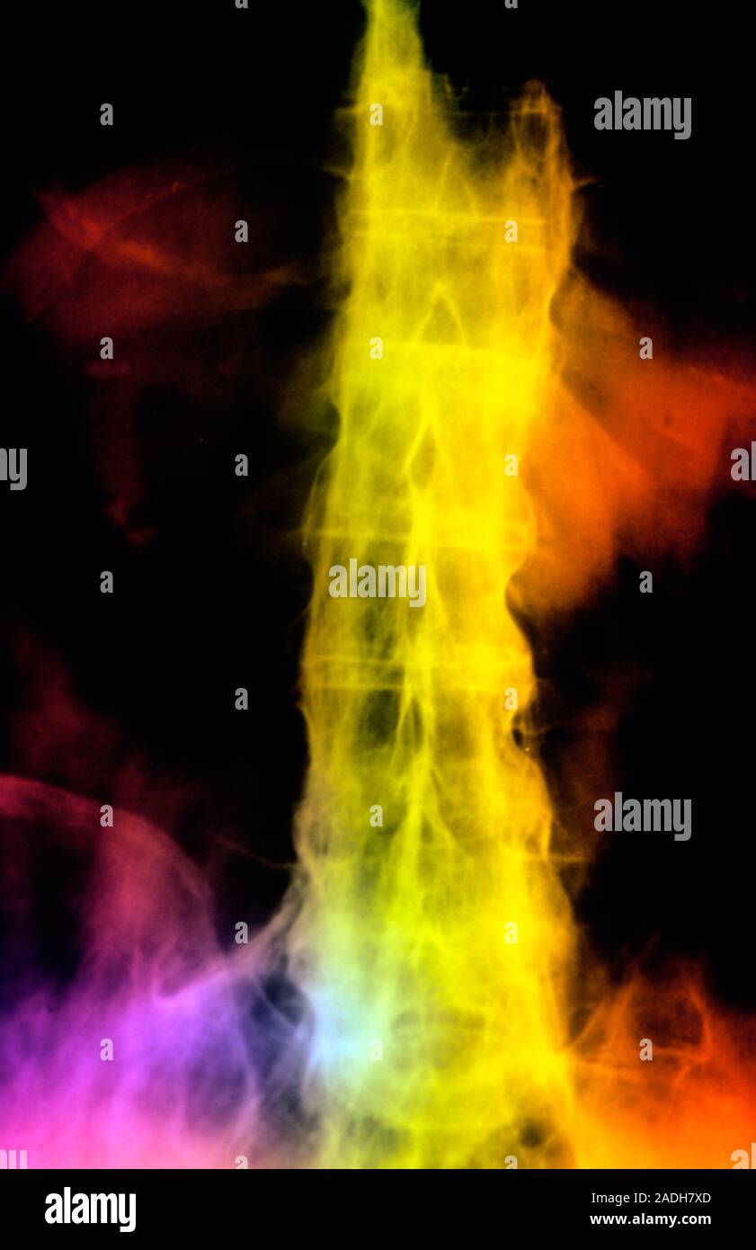 False-colour X-ray of the lumbar and sacral spine in ankylosing ...