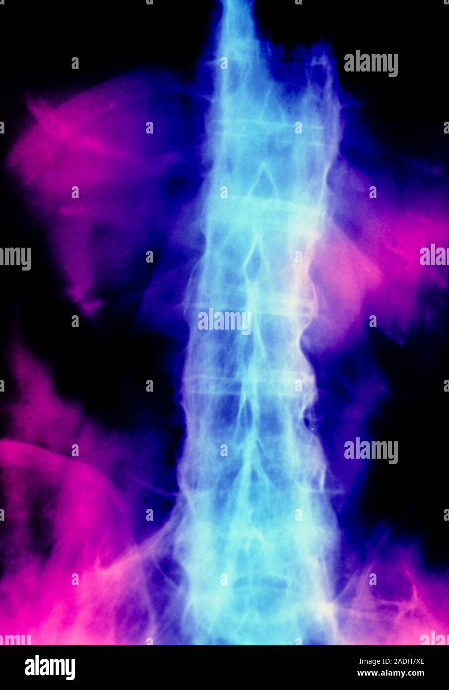 False-colour X-ray of the lumbar and sacral spine in ankylosing ...