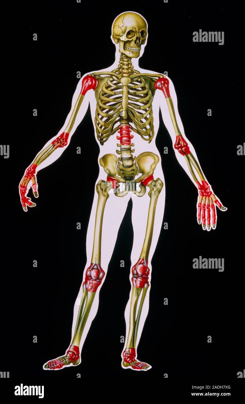 Illustration of arthritis sites on the body. Arthritis is not a single ...