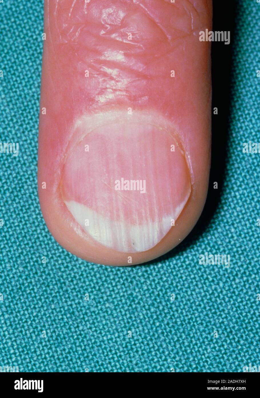 Ridging of a fingernail in a patient with rheumatoid arthritis ...
