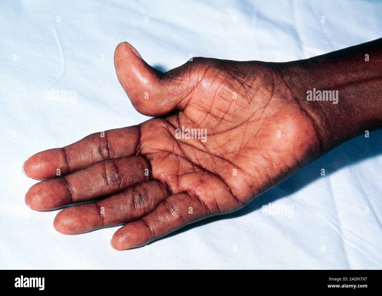 Deformity of the thumb in a Jamaican patient suffering from rheumatoid ...