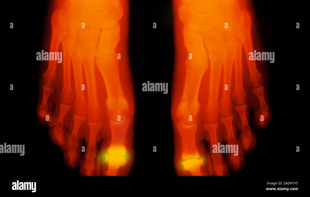 Rheumatoid arthritis. False-colour X-rays showing destruction of the ...