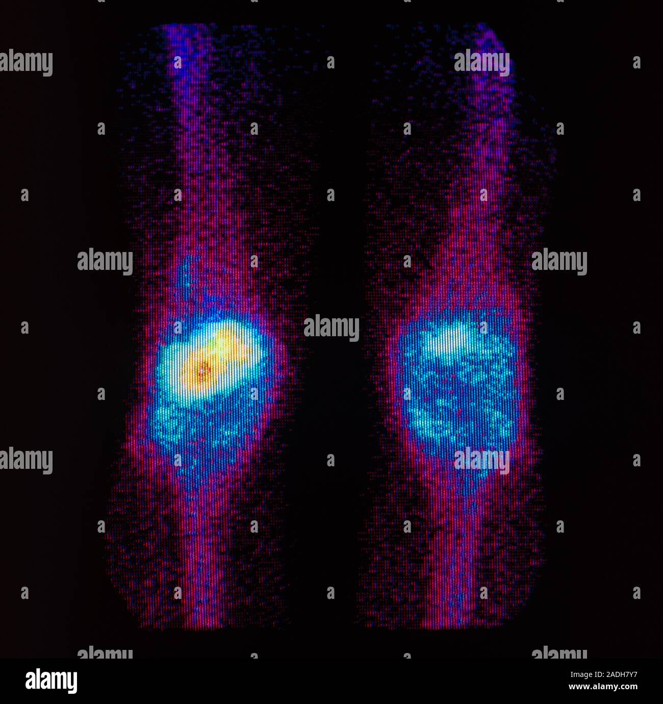 Arthritis. Coloured gamma camera scan of a patient's knee joints ...