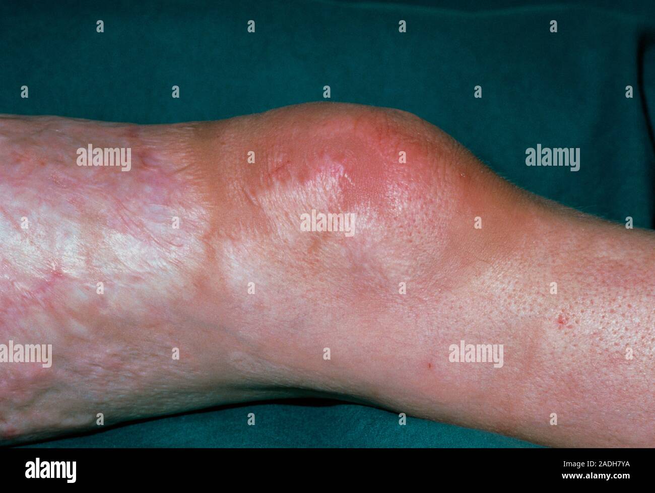 Acute non-septic monoarthritis of knee. This is a close up of a patient ...
