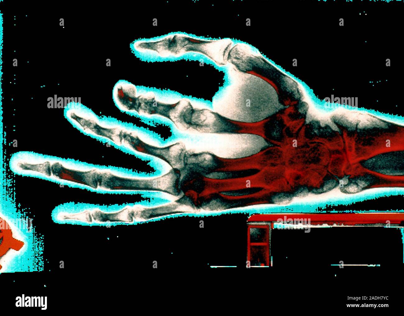 Arthritic hand. Coloured digitised X-ray of a hand showing evidence of ...