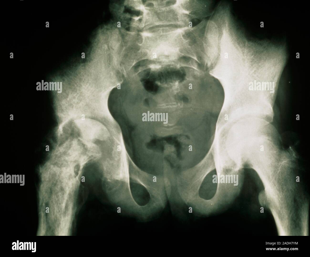 Septic arthritis. X-ray of a human pelvis showing deterioration of the ...