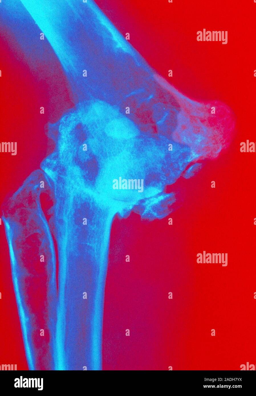 Rheumatoid arthritis. Coloured X-ray showing dislocation and ...
