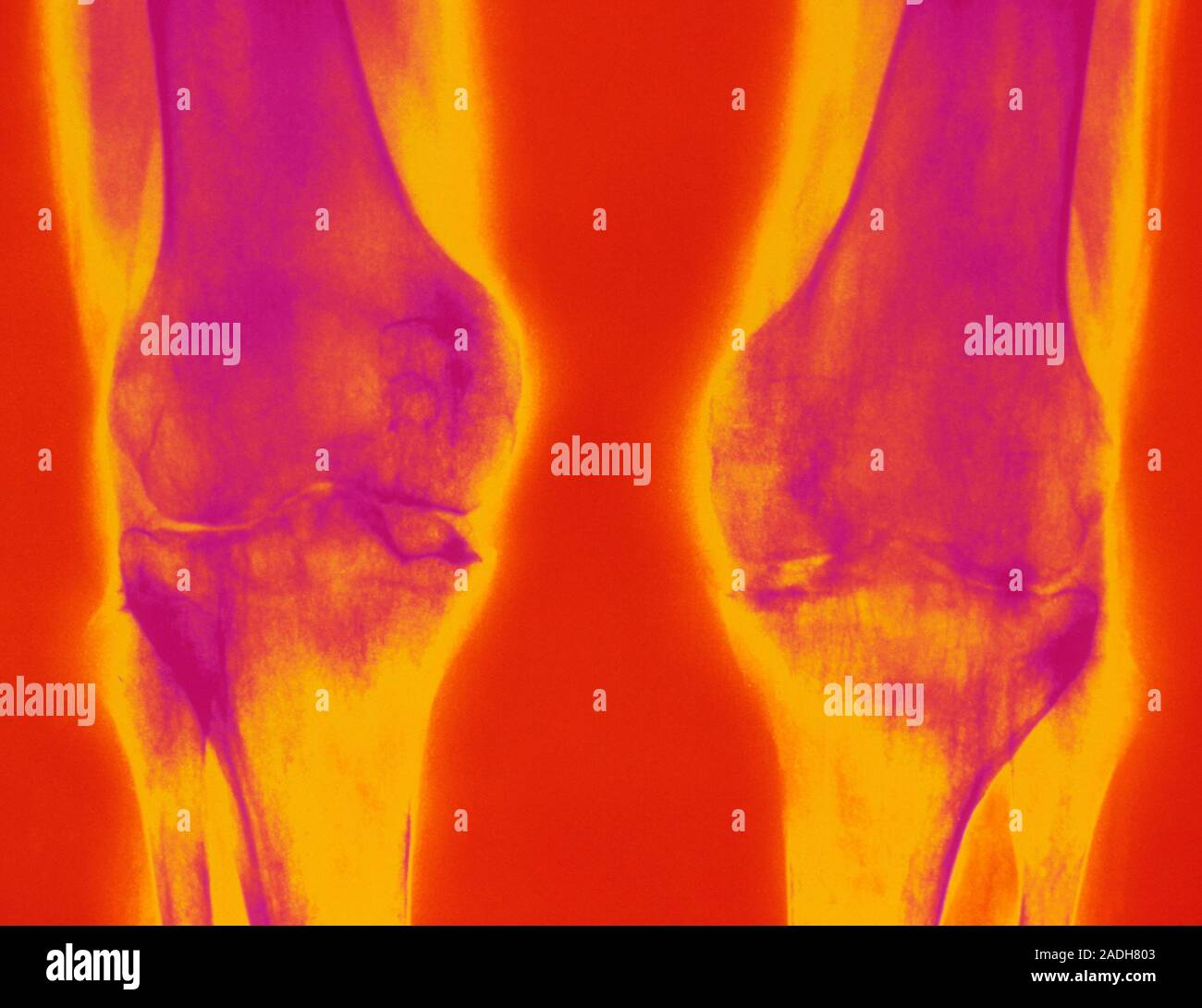 Coloured X-ray showing erosion of both knee joints due to rheumatoid ...
