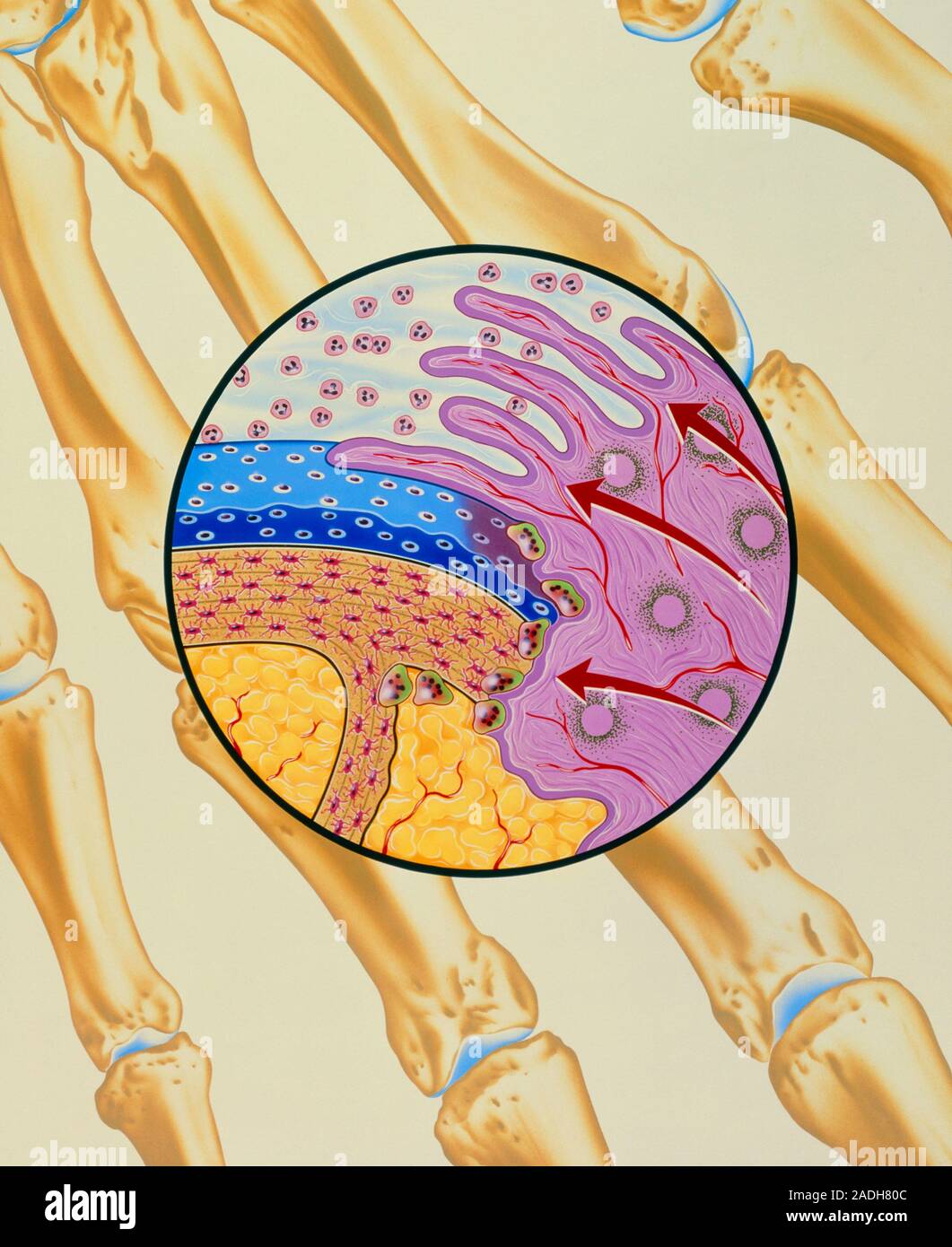 Rheumatoid arthritis. Illustration showing the mechanism of rheumatoid ...