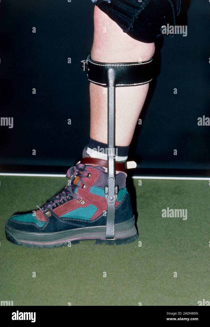 Calliper splint in arthritis. A calliper splint fixed to the ankle of a ...