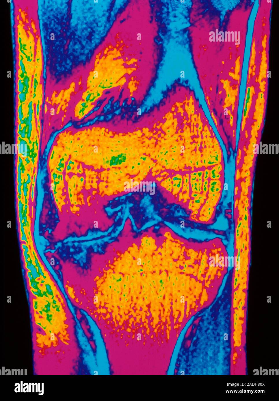 Osteoarthritis of knee. Colour Magnetic Resonance Imaging (MRI) scan of ...