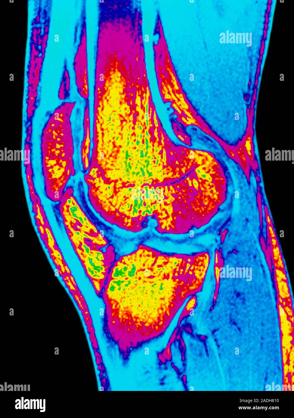 Osteoarthritis of knee. Colour Magnetic Resonance Imaging (MRI) scan of ...