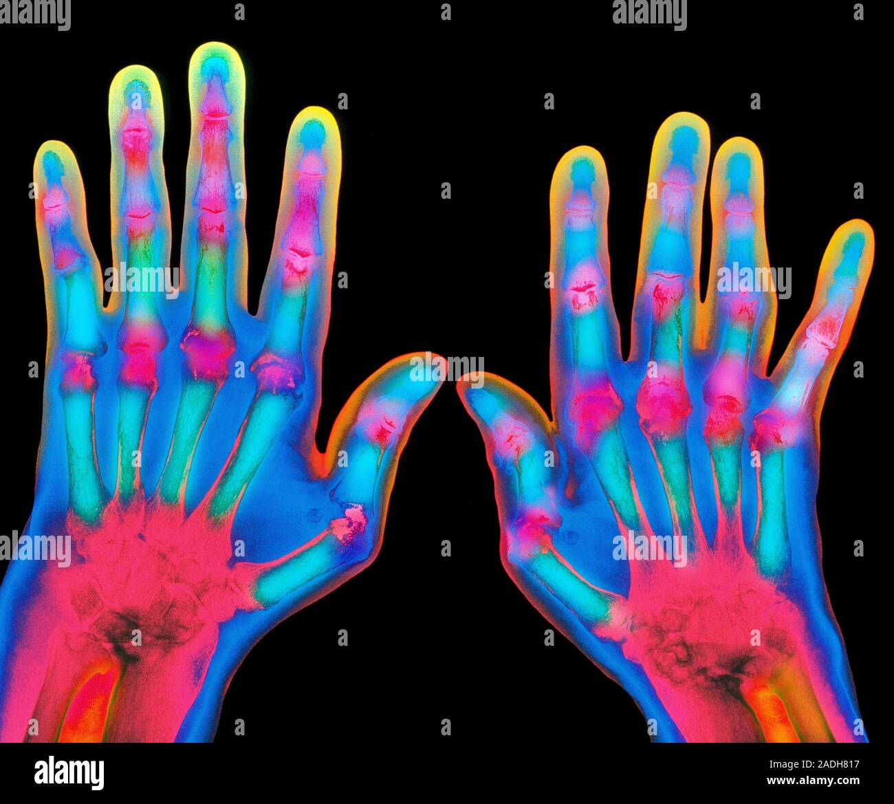 Arthritic hands. Coloured X-ray of hands suffering from severe ...