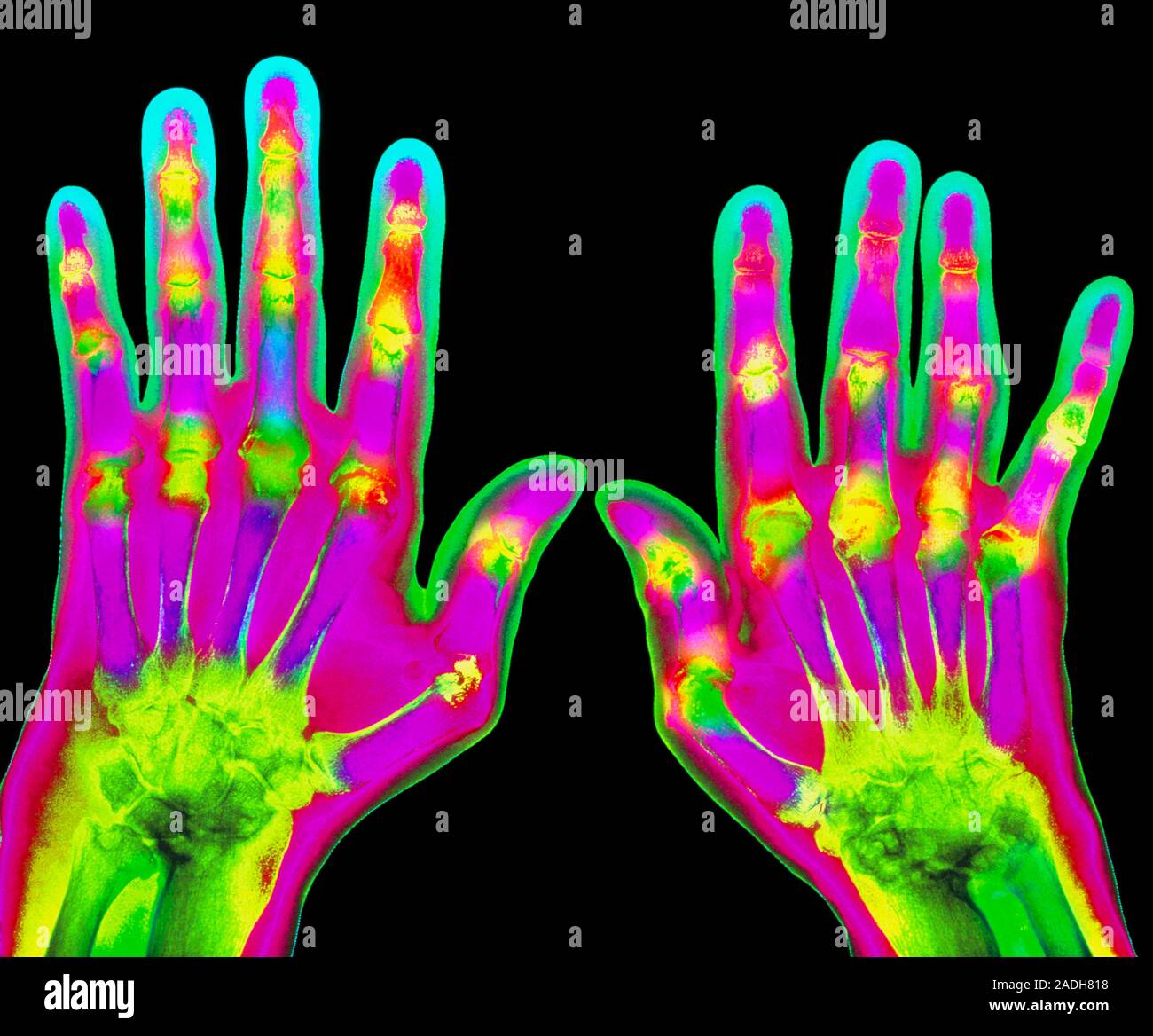 Arthritic hands. Coloured X-ray of hands suffering from severe ...