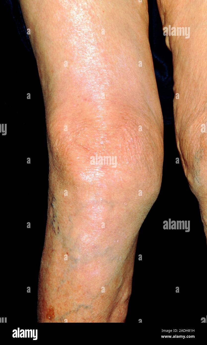 Osteoarthritis. Swollen knee joint of a 94 year- old woman affected by ...