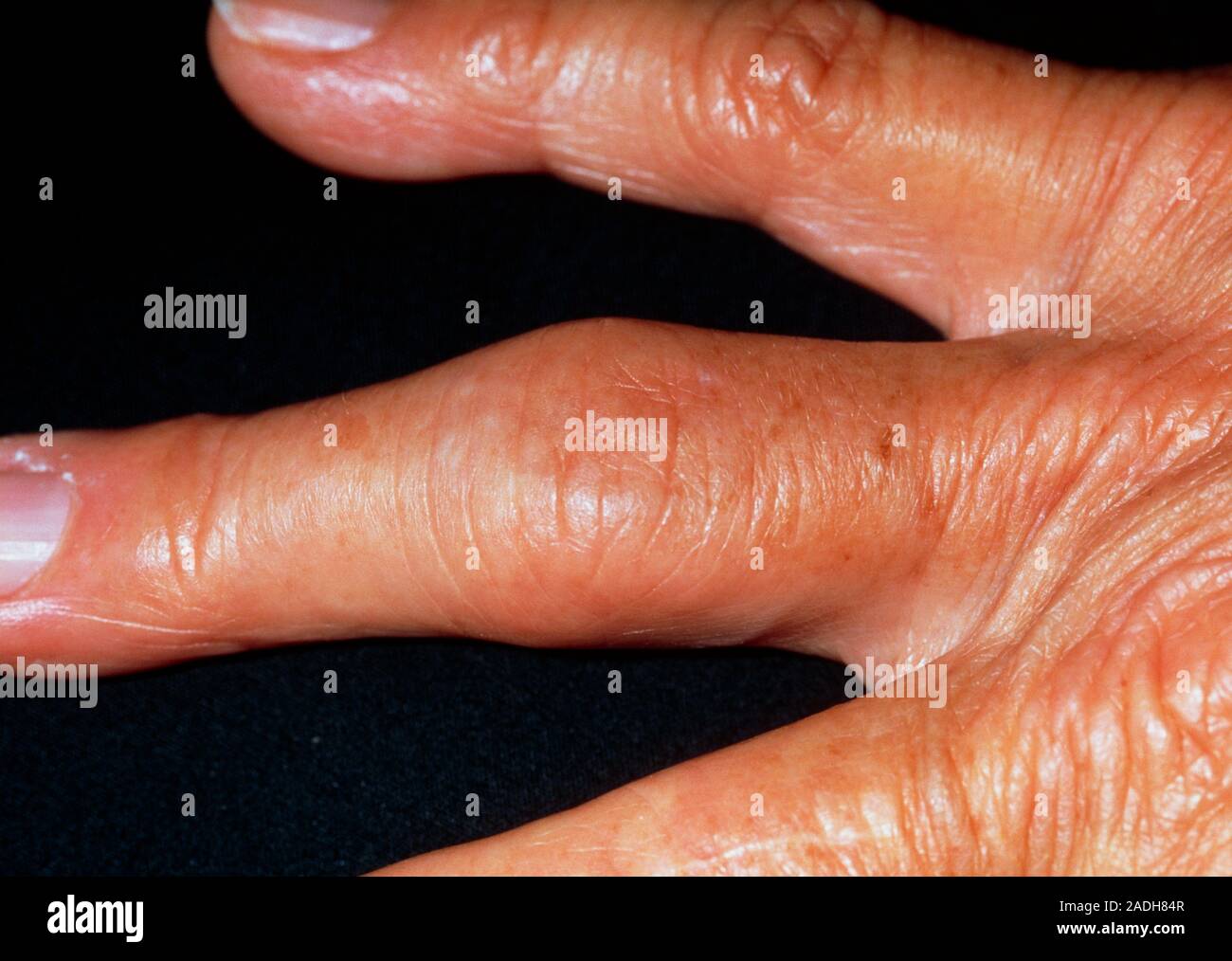 Osteoarthritis. View of the hand of a 69 year old woman showing fingers ...