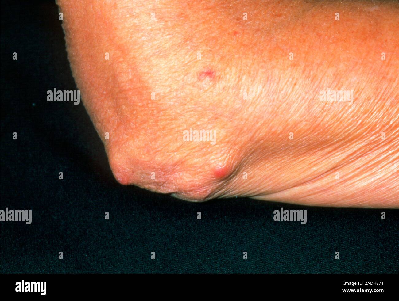Rheumatoid arthritis nodule. Hard swellings (nodules) on the elbow of a ...