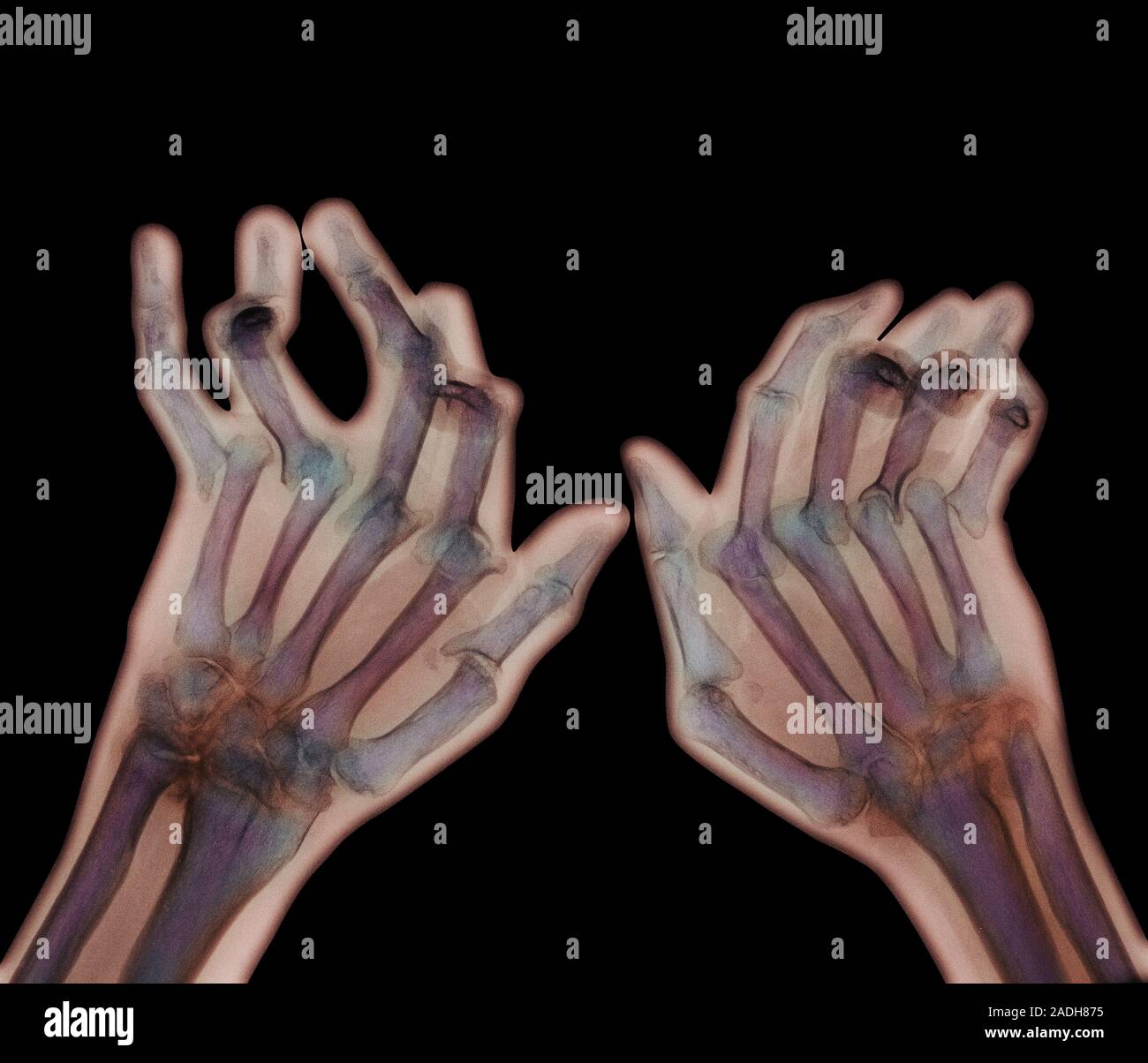 Arthritic hands. Coloured X-ray of the deformed hands of a patient ...