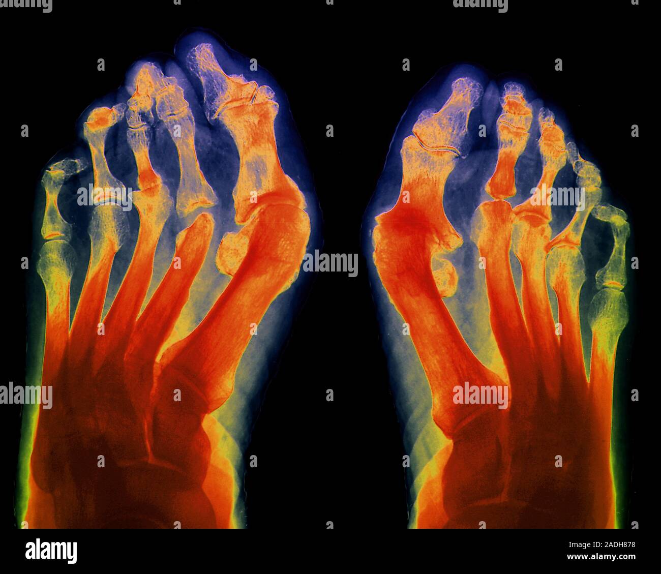 Arthritic feet. Coloured X-ray of the deformed feet of a patient ...