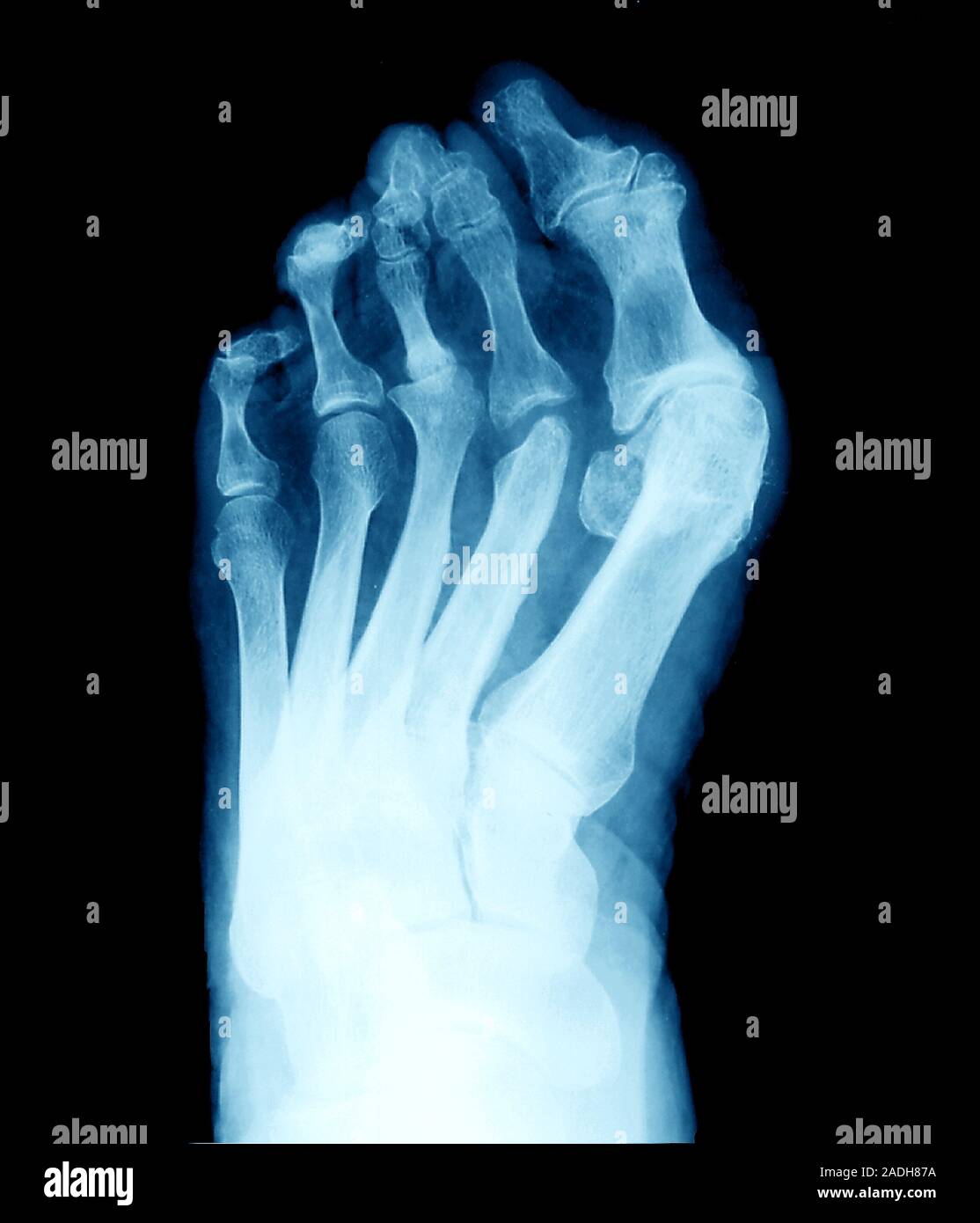 Rheumatoid Arthritis Feet Xray Rheumatoid Arthritis X Ray Wikidoc