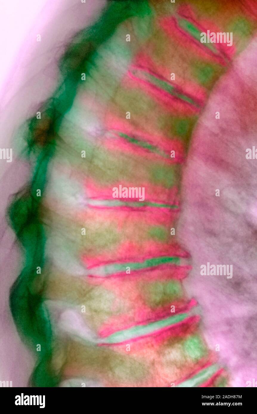 Arthritis of the spine, coloured X-ray. The discs of cartilage ...