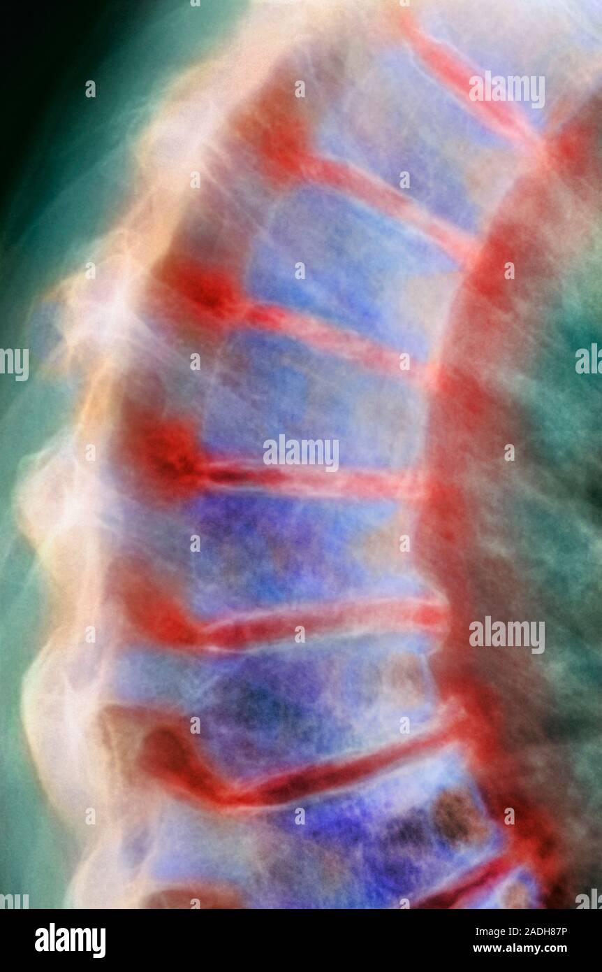Arthritis of the spine, coloured X-ray. The discs of cartilage (red ...