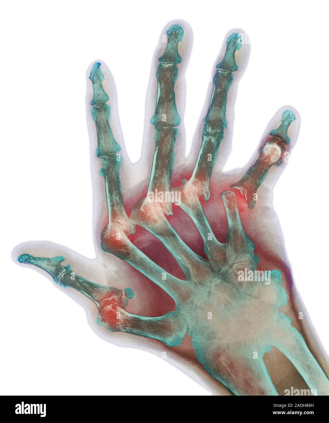 Arthritic hand. Coloured X-ray of the deformed hand of a patient ...